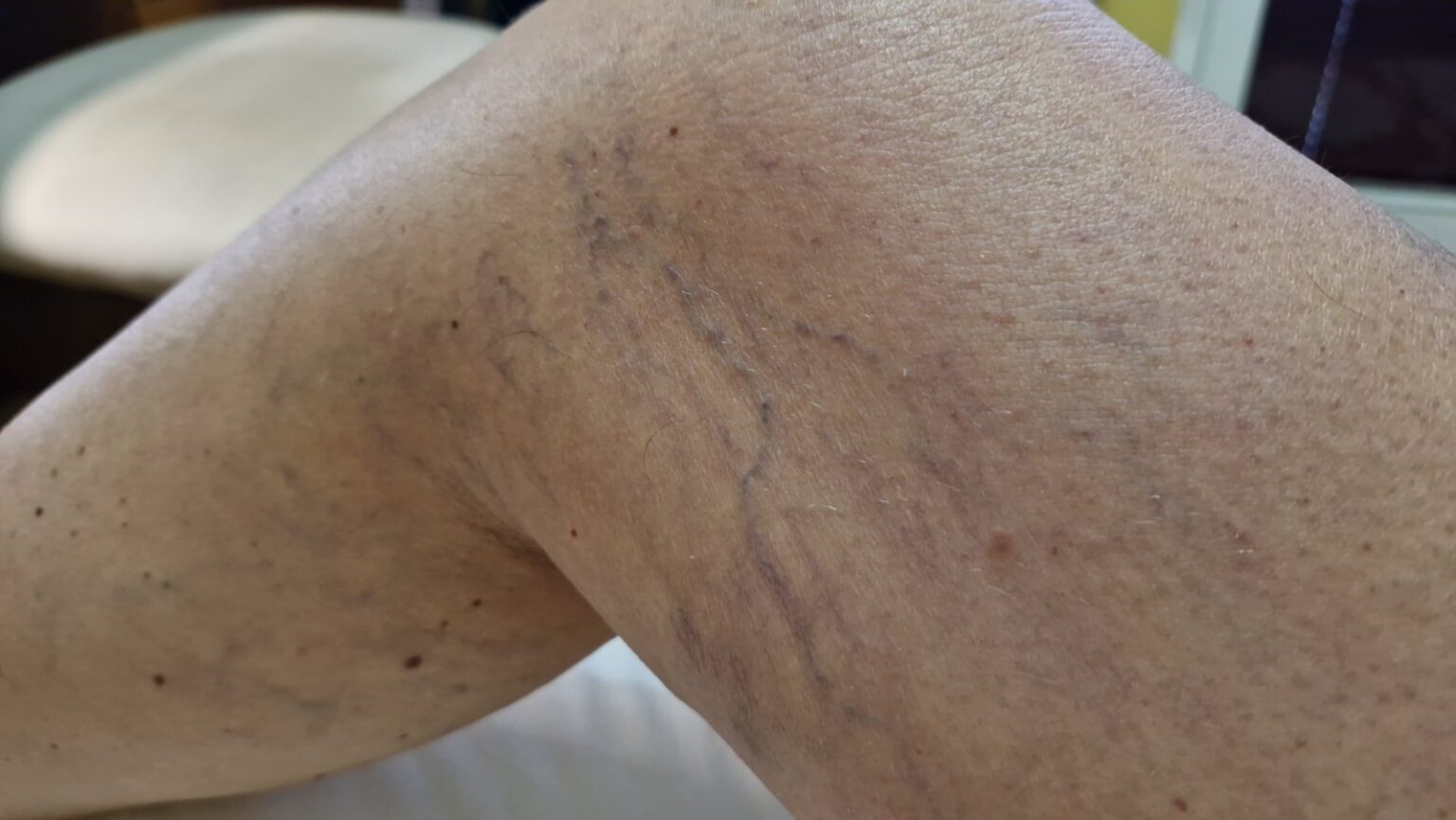 Kapilari i vene - sklerozacija i drugi mogući i načini lečenja ...